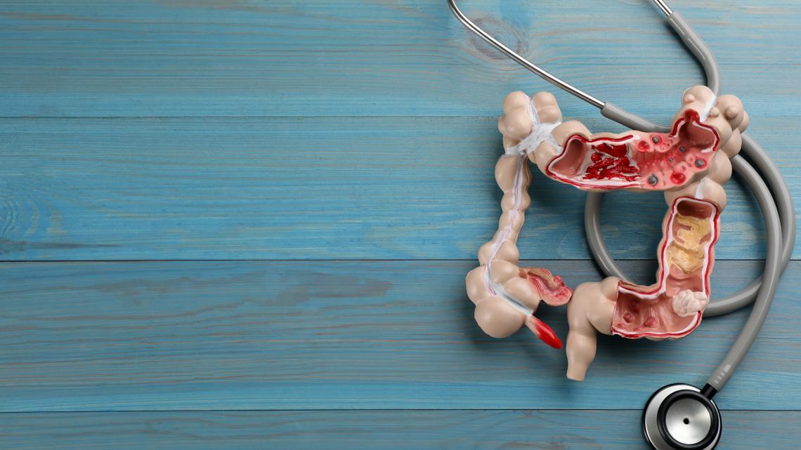 Ultra-processed foods linked to higher colon polyp risk, study shows ...