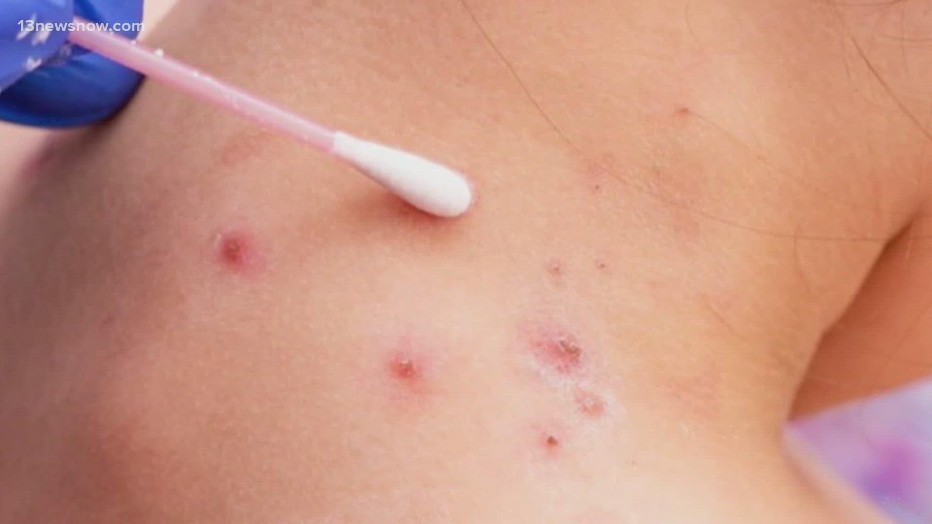 Health alert: Measles outbreak confirmed in Buckingham County, Virginia ...